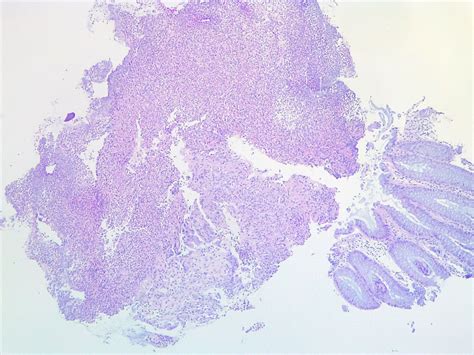 Refractile Basophilic Crystal With Typical Fish Scale Morphology
