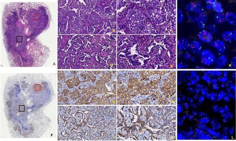 A F Images Display The Acinar Adenocarcinoma And Solid Download