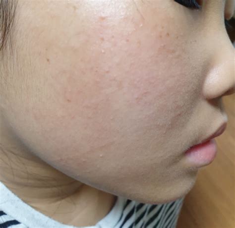 儿童特应性皮炎：毛周角化症改善过程 知乎