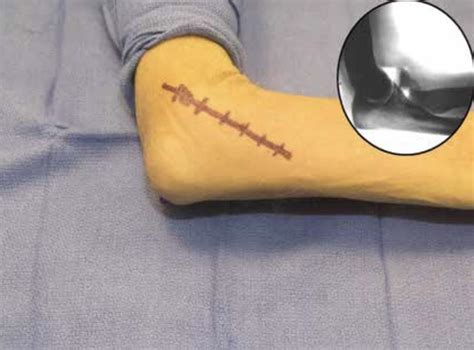 Align® Radial Head System Implants Orthobullets