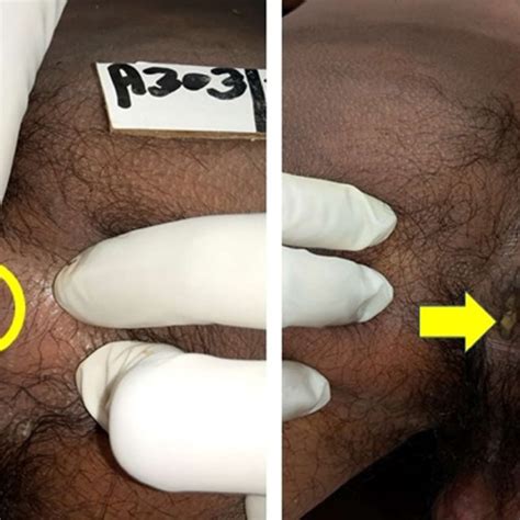A An Old Infected Sinus At 12o Clock Position In The Prone Position Download Scientific