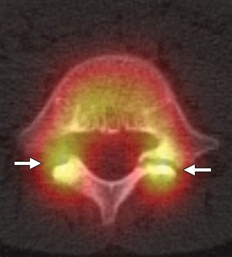 Spondylolysis And Beyond Value Of Spect Ct In Evaluation Of Low Back