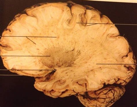 Deep Telencephalon Structures Quiz