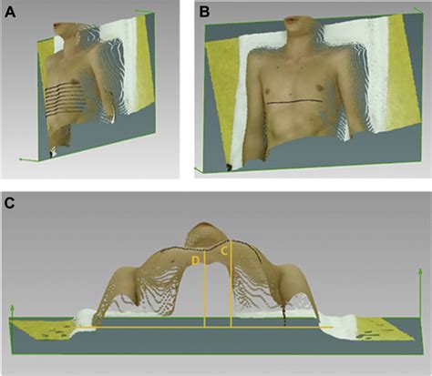 A Novel Objective Approach To The External Measurement Of Pectus