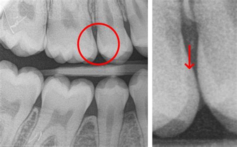 Interproximal Initial Caries Treated With Curodont Repair And Curodont