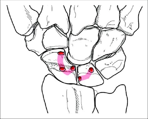 Scaphoid Shaped Abdomen
