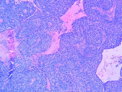 Basaloid Squamous Cell Carcinoma Histopathologyguru