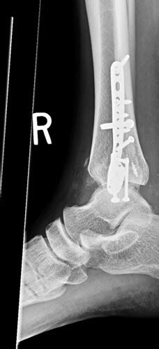 Two Broken Ankles X Rays After Second Surgery