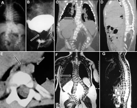 A Radiograph Of The Spine Shows Complex Malformation With Complete