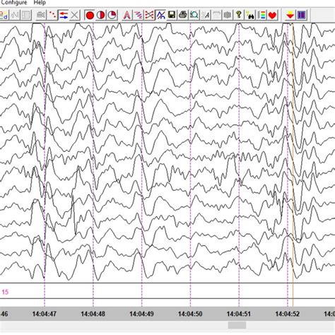The Eeg Shows Short Generalized Slow Spike Discharges Separated By