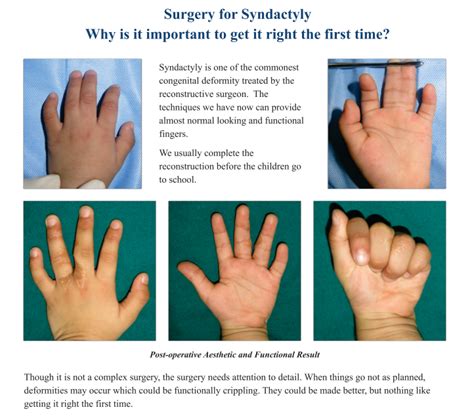Fused Finger Surgery Hospital In Coimbatore Fused Finger Treatment