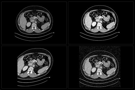 Deep Learning In Medical Imaging Data Augmentation
