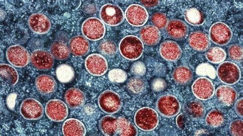 Who Chief Advises Reducing Sex Partners As Monkeypox Cases Surge