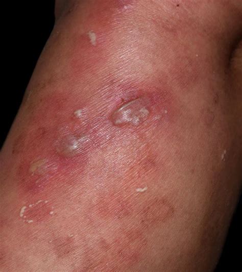 Vesicular Skin Lesions Causes Symptoms Diagnosis Treatment