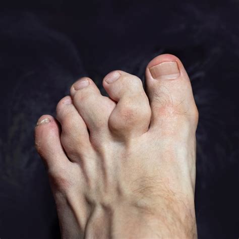 Overlapping Toes Correction Restore Comfort And Alignment