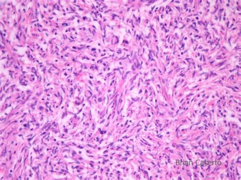 Sarcoma Of Histiocytic Or Splenic Stromal Origin Veterinary Pathology