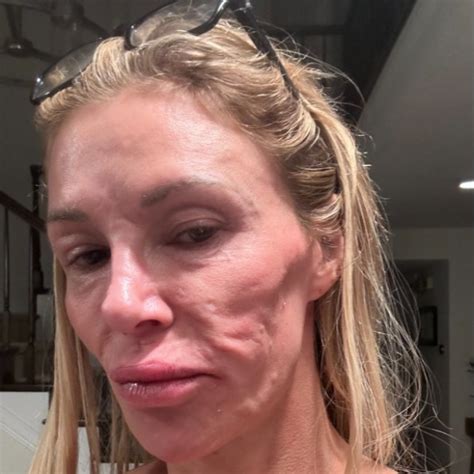 Brandi Glanville Hasnt Had Sex In More Than A Year Due To Facial