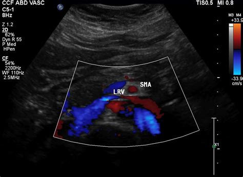 Renal Nutcracker Syndrome Surgery At Nelson Roberto Blog