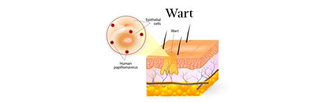What Are Hpv Genital Warts Signs You Should Know