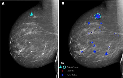 Ai Performs Comparable To Humans In Reading Mammograms Applied Radiology