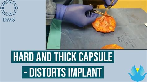 Capsular Contracture Massage At Roy Breeden Blog