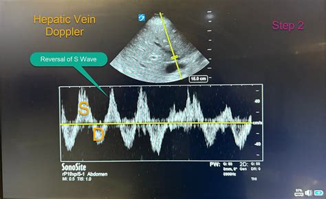 Understanding The Vexus Score A Case Example Of Grade 3 Congestion