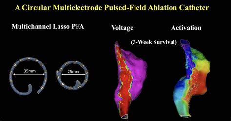 Circular Multielectrode Pulsed Field Ablation Catheter Lasso Pulsed