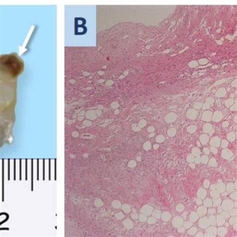 A Polypoid Fibrolipoma In Donor Left Atrium The Arrow Indicates The
