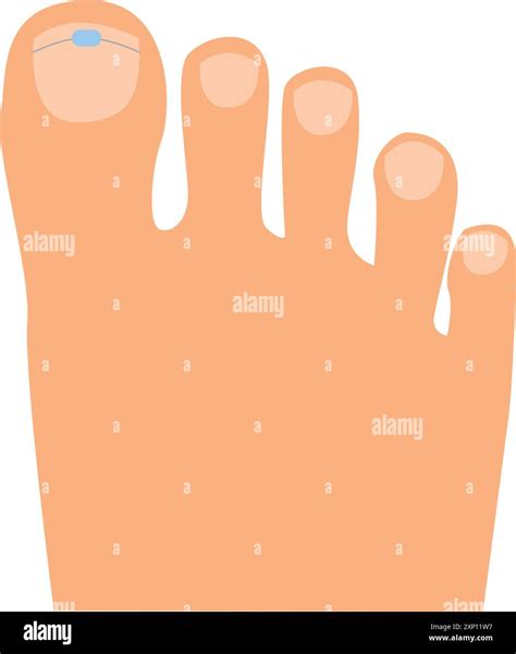 Toes On The Right Foot With A Titanium Staple On The Thumb For Correction Of The Shape Of The