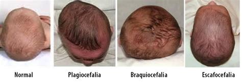Deformidad Craneal En Bebés Qué Es Tipos Causas Y Tratamiento