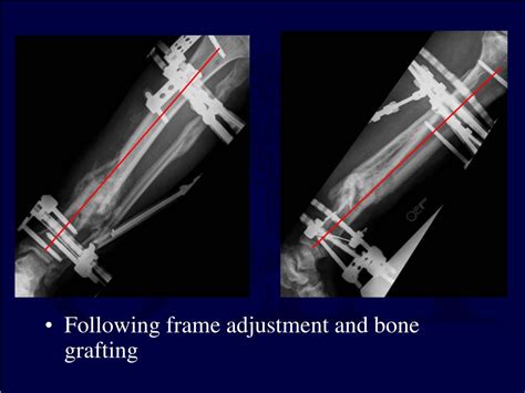 Ppt Principles Of External Fixation Powerpoint Presentation Free