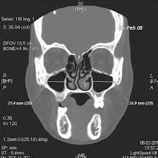 Ct Scan Maxilla Axial Medifyhome