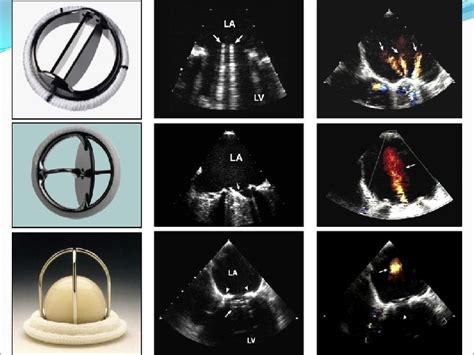 Echocardiographic Evaluation Of Prosthetic Valves Part I Echo