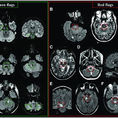 Characteristics Of Gadolinium Enhancing Multiple Sclerosis Lesions That Download Scientific