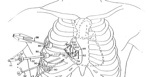 胸腔鏡手術thoracoscopy 小小整理網站 Smallcollation