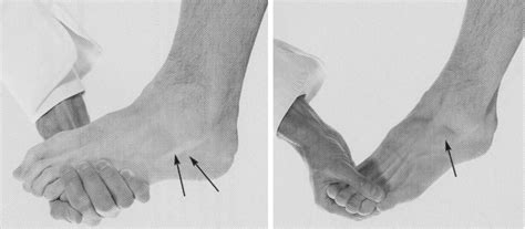 Common Peroneal Nerve Lesions • Litfl • Ffs