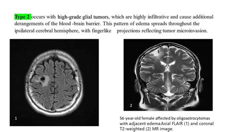 Example Of Type 1 Of Peritumoral Vasogenic Edema In A 56 Year Old