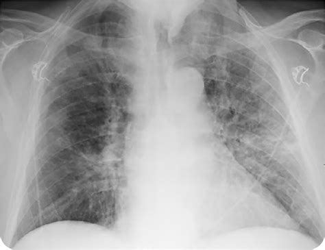 Multifocal Pneumonia Fever Cough And Dyspnea Aafp