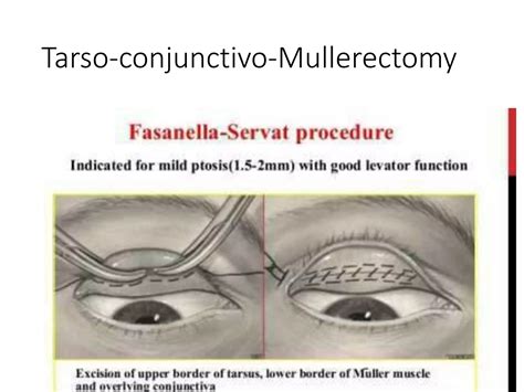 Ptosis Pptx Eye And Vision Conditions Diseases And Conditions