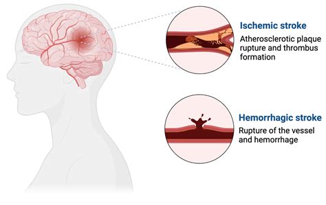 Neuro Transunet Segmentation Of Stroke Lesion In Mri Using