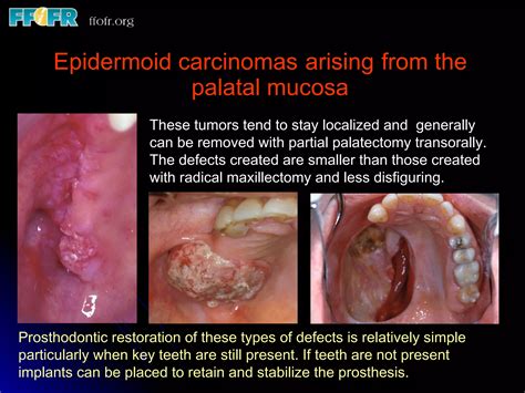 10 Etiology Of Palatal And Paranasal Sinus Defects Ppt Ear Nose And Throat Conditions