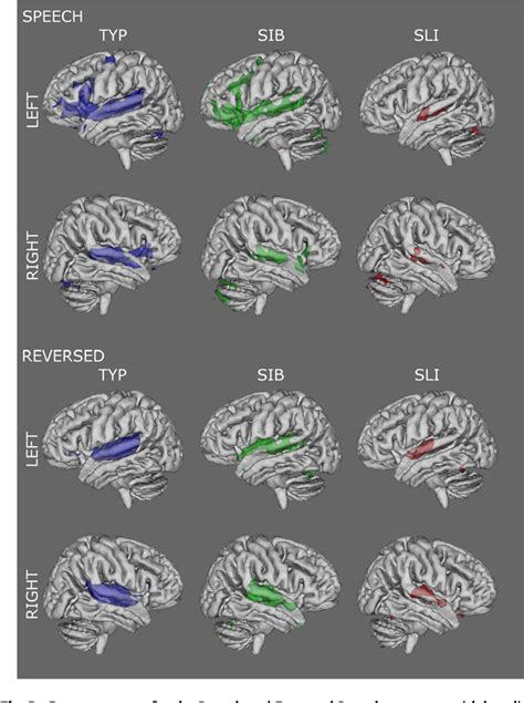 Figure 2 From Co Localisation Of Abnormal Brain Structure And Function