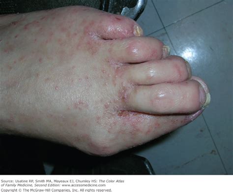 Scabies Basicmedical Key