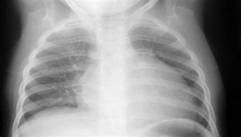Miocarditis Causas Síntomas Y Secuelas Salud