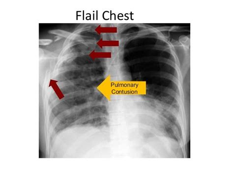 Flail Chest X Ray