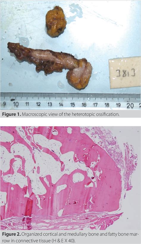 Figure 2 From Heterotopic Ossification Of The Anterior Abdominal Wall