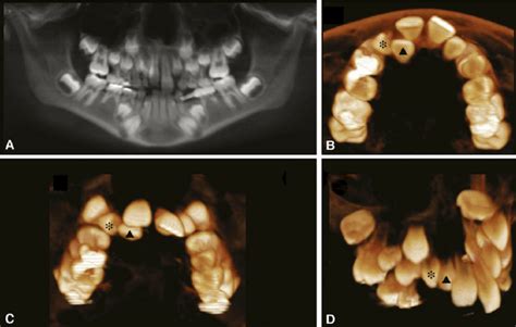 Cbct Scan For Supernumerary Tooth Oral Radiology Toronto