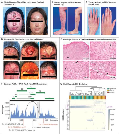 皮肤癌：hpv也是一个潜在的原因吗？ 疫苗网