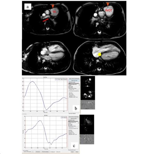 A Case Of Post Tof Repair A Dilated Pulmonary Patch And Rvot