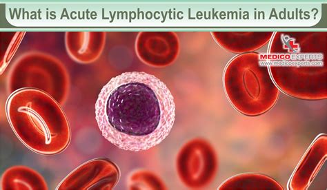 Acute Leukemia In Adults A Closer Look